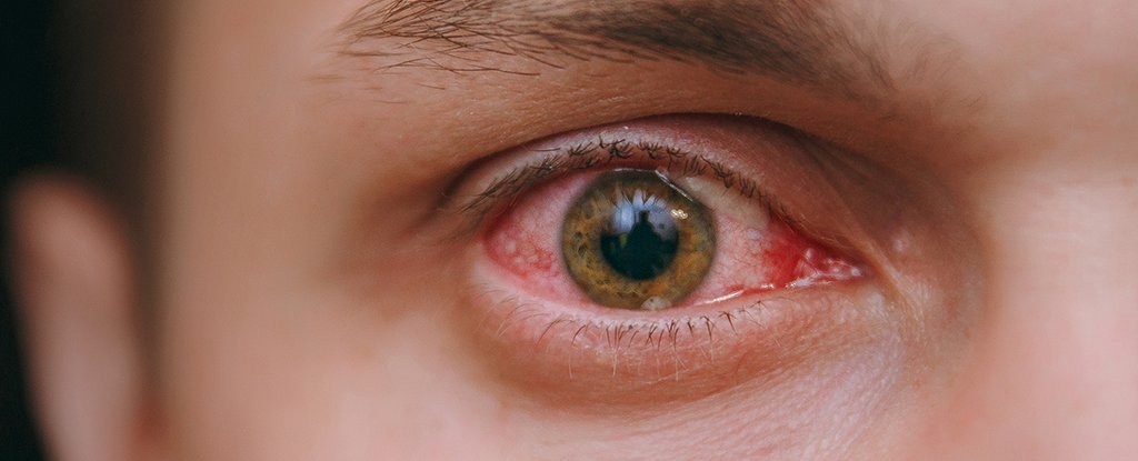 Bloodshot Eyes Drugs