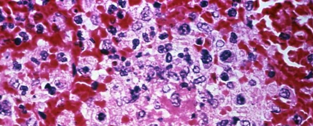 Deadly Meningitis Appears to Be Cleared With Antipsychotics in Early ...