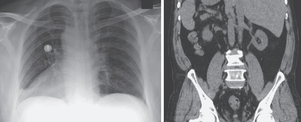 Wild Case Study Reveals 66-Year-Old Man With All His Organs on The ...