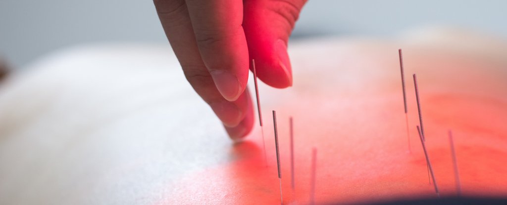 'Extremely Deep' Acupuncture Treatment Ends Up Piercing Patient's Lungs ...