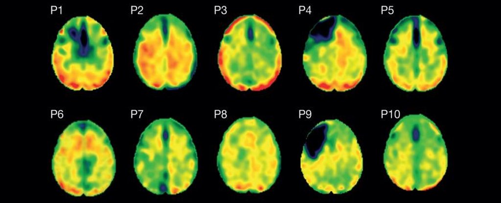 Just One Head Injury Could Be Enough to Tangle Proteins in Your Brain ...