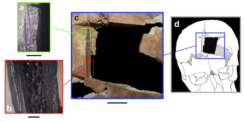 3,500-Year-Old Failed Attempt at Brain Surgery Uncovered in Israel ...
