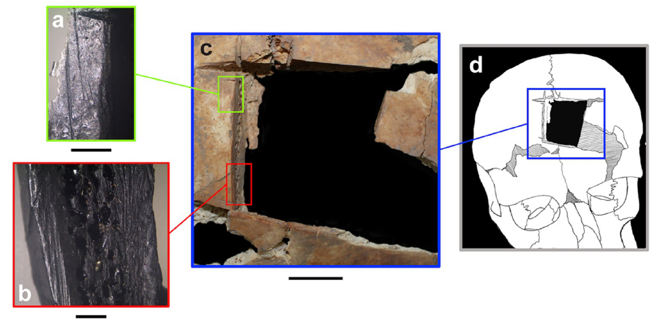 3,500-Year-Old Failed Attempt at Brain Surgery Uncovered in Israel ...