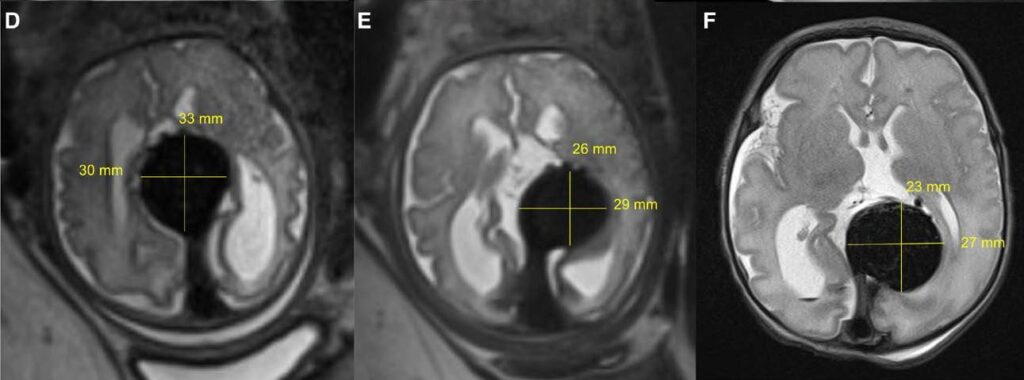 Doctors Conduct Brain Surgery on Fetus in Womb in World First ...