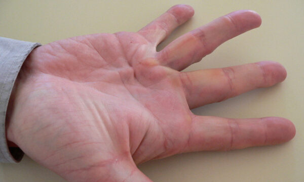 'Viking Disease' Hand Disorder May Come From Neanderthal Genes ...