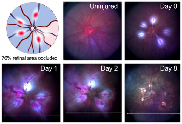 Eye Drops Could Replace Injections For a Common Retina Disease ...