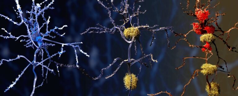 Brain Autopsies Revealed a Potential Culprit Behind Alzheimer's ...