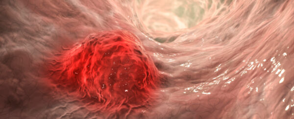 Common Forever Chemicals May Trigger Cancer Cells to Spread : ScienceAlert