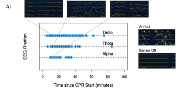 Study: Near-Death Patients Reveal Brain Activity After Heart Stopped ...