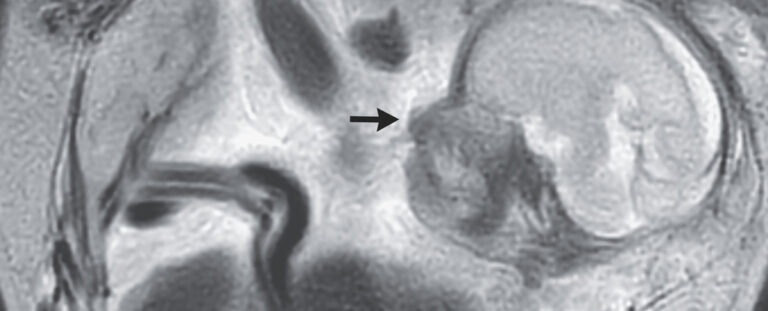 Baby Survives Incredibly Rare Pregnancy Outside of Mother's Uterus ...