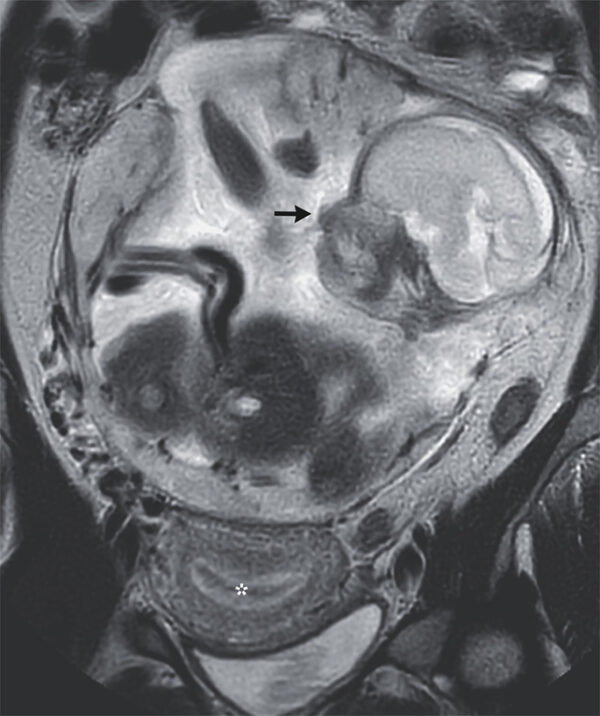 Baby Survives Incredibly Rare Pregnancy Outside of Mother's Uterus ...