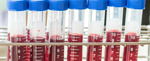 A Single Drop of Blood Could Soon Reveal Your Risk of Developing MS ...