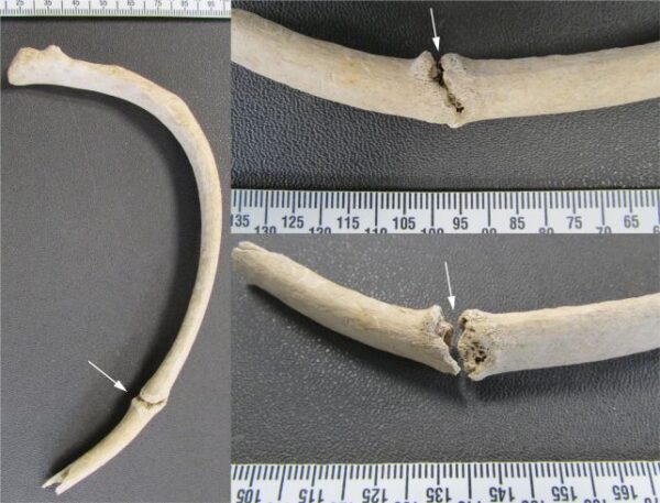 'Brutalized' Iron Age Skeleton Is Rare Evidence of Human Blood ...