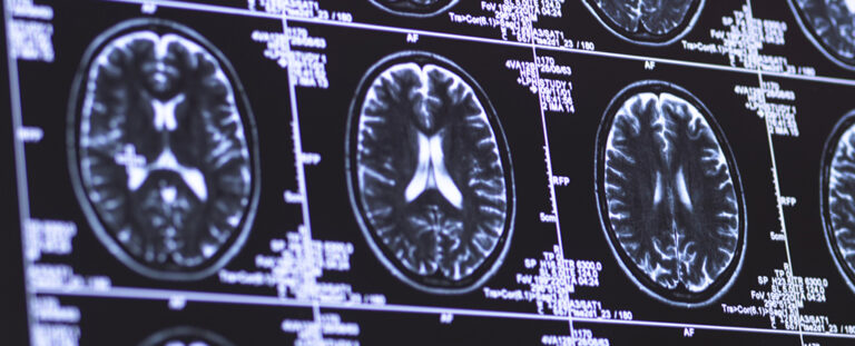 Dementia Breakthrough: Brain Scans Predict Disease Up to 9 Years Early ...