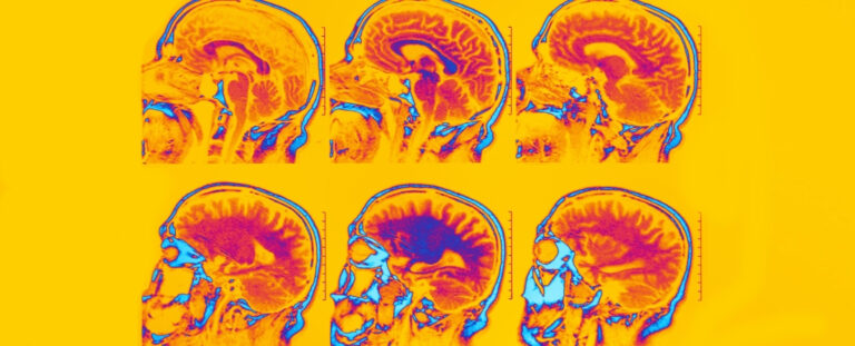 Brain Scans Identify Six Distinct Types of Depression And Anxiety ...