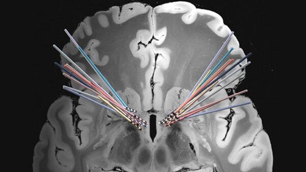 The Neural Signature of OCD Has Been Identified in The Human Brain ... The Neural Signature of OCD Has Been Identified in The Human Brain ...