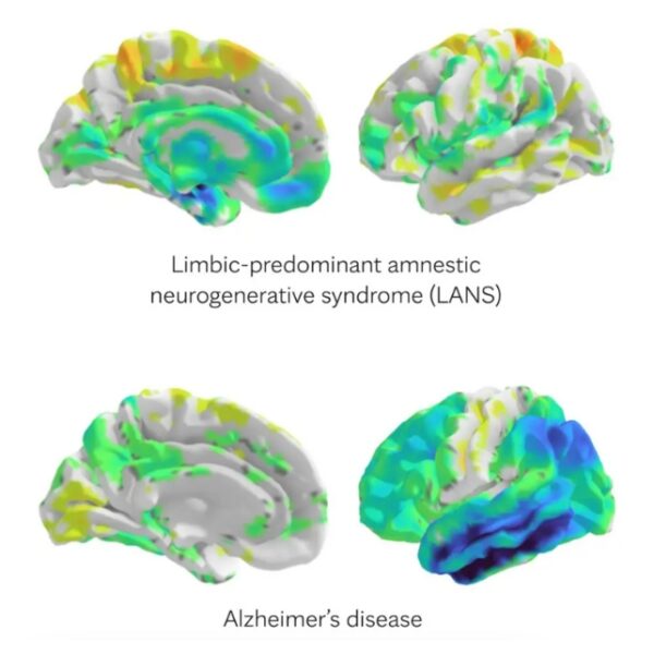 Scientists Name New Type of Memory Loss Often Mistaken For Alzheimer's ...