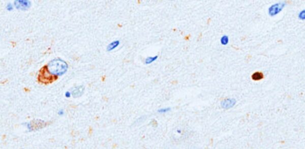 Scientists Name New Type of Memory Loss Often Mistaken For Alzheimer's ...