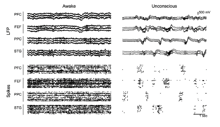 Common Sedative Could Break Consciousness by Tipping Your Brain Into ...