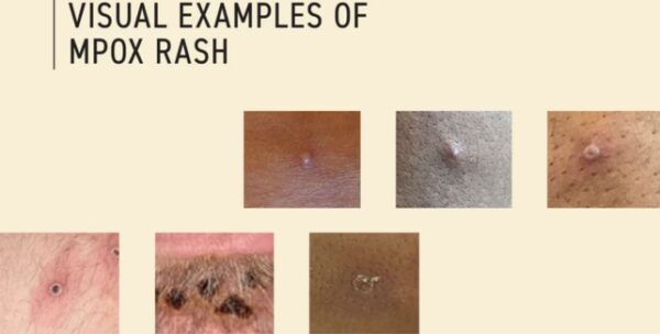 Mpox Has Infected Nearly 100,000 People. Here's What You Need to Know ...