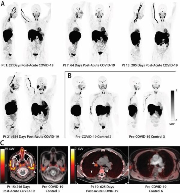 COVID's Hidden Toll: Full-Body Scans Reveal Long-Term Immune Effects ...