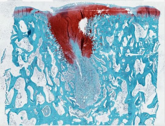 New Biomaterial Could Finally Repair Damaged Cartilage in Injured ...