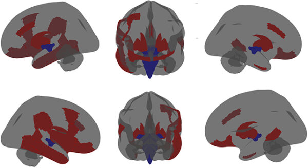 Brain Scans Show Neuron Structures Look Different in Kids With Autism ...