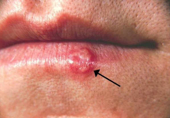 The Cold Sore Virus Can Infect Your Brain. But How Does It Get Inside ...