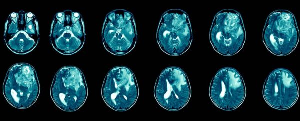 The Deadliest Kind of Brain Cancer May Have a Promising New Treatment ...