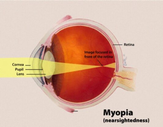 Myopia in Kids Is Rising. Here's How to Protect Your Child's Vision ...