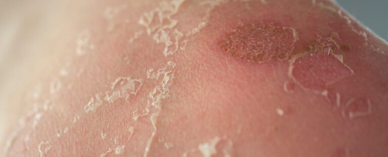 A Rare, Fatal Skin Disease Has Been Cured in Patients For The First ...