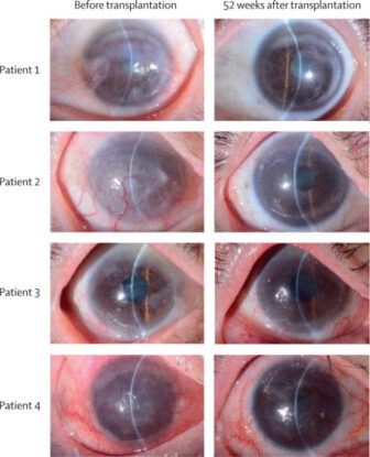 World First: Stem Cell Transplant Restores Vision in Multiple People ...
