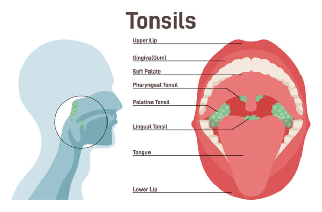 Your Tonsils Can Actually Come Back After You've Had Them Removed ...