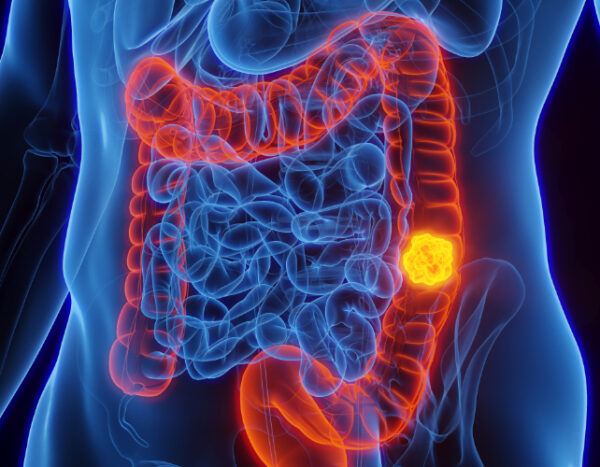 The US Just Updated Its Guidelines to Detect And Prevent Colorectal ...