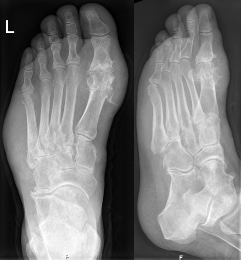 Massive Study Shows Where Gout Comes From, And It's Not What We Thought ...
