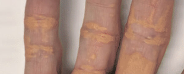 Man's Carnivore Diet Causes Strange Yellow Deposits on Skin : ScienceAlert