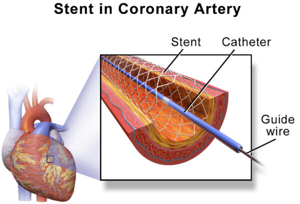 Doctor Realizes He's Having a Heart Attack While Treating Heart Attack ...
