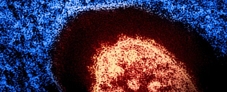 First US Measles Death in 10 Years: Expert Explains How to Protect ...