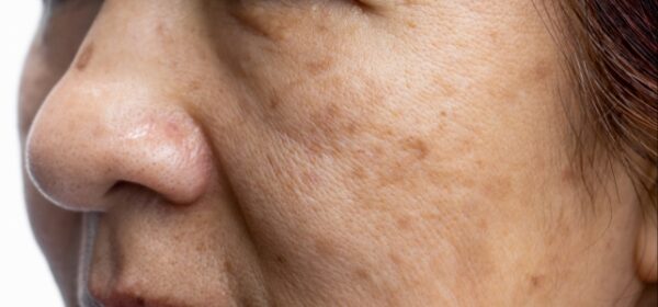 Freckle, Sunspot, or Mole? An Expert Explains How to Tell The ...