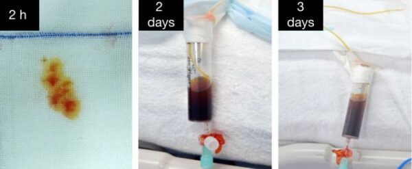 Pig Liver Successfully Transplanted Into Human Patient in World First ...
