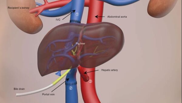 Pig Liver Successfully Transplanted Into Human Patient in World First ...