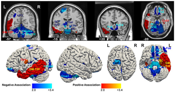 Scans Reveal What The Brains of Psychopaths Have in Common : ScienceAlert
