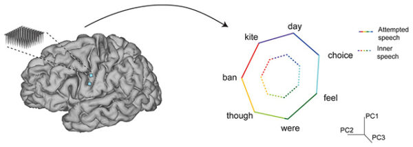 This Incredible Brain Implant Can Decode Inner Thoughts Into Speech ...