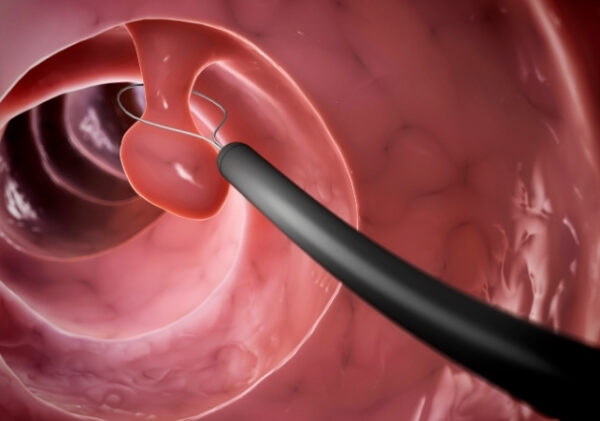 Surprise Discovery of Elevated Cancer Risk in Elite Runners Can Be ...