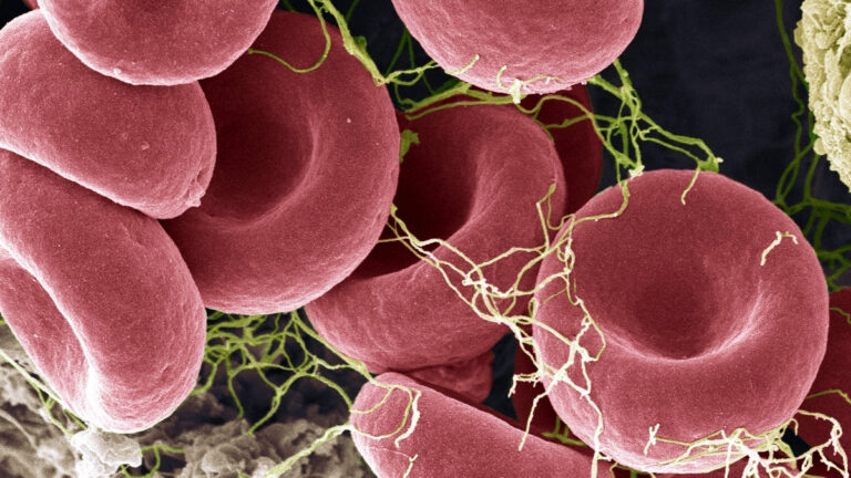 Can a New Blood Test Actually Detect ME/CFS? Here's What We Know ...