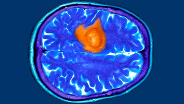 The 7 Warning Signs of Brain Cancer You Might Easily Miss : ScienceAlert