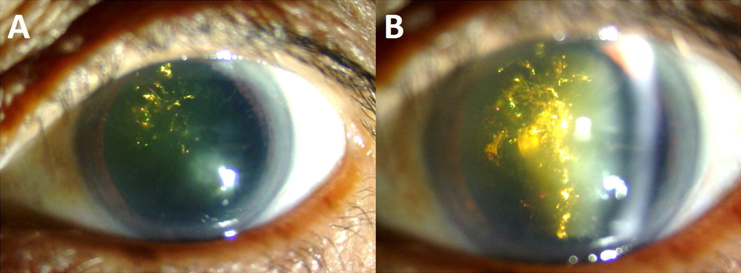 This Rare Condition Makes Your Eyes Sparkle Like a Christmas Tree ...