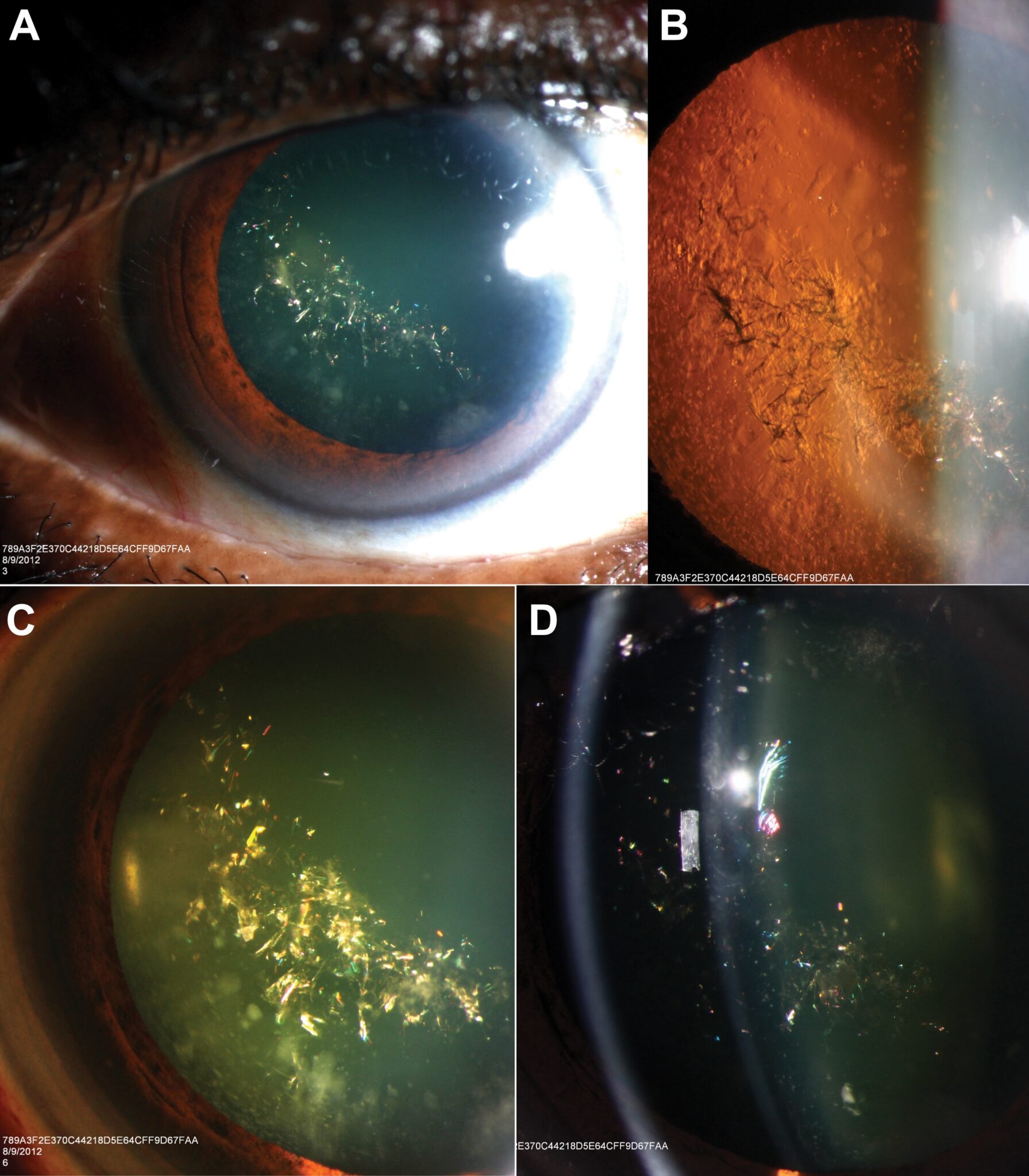 This Rare Condition Makes Your Eyes Sparkle Like a Christmas Tree ...