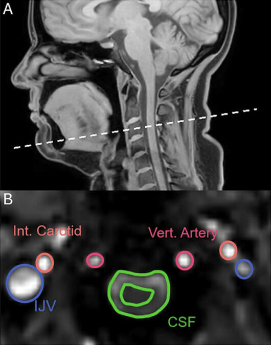 Yawning Does Something Surprising in Your Brain, MRI Scans Reveal ...