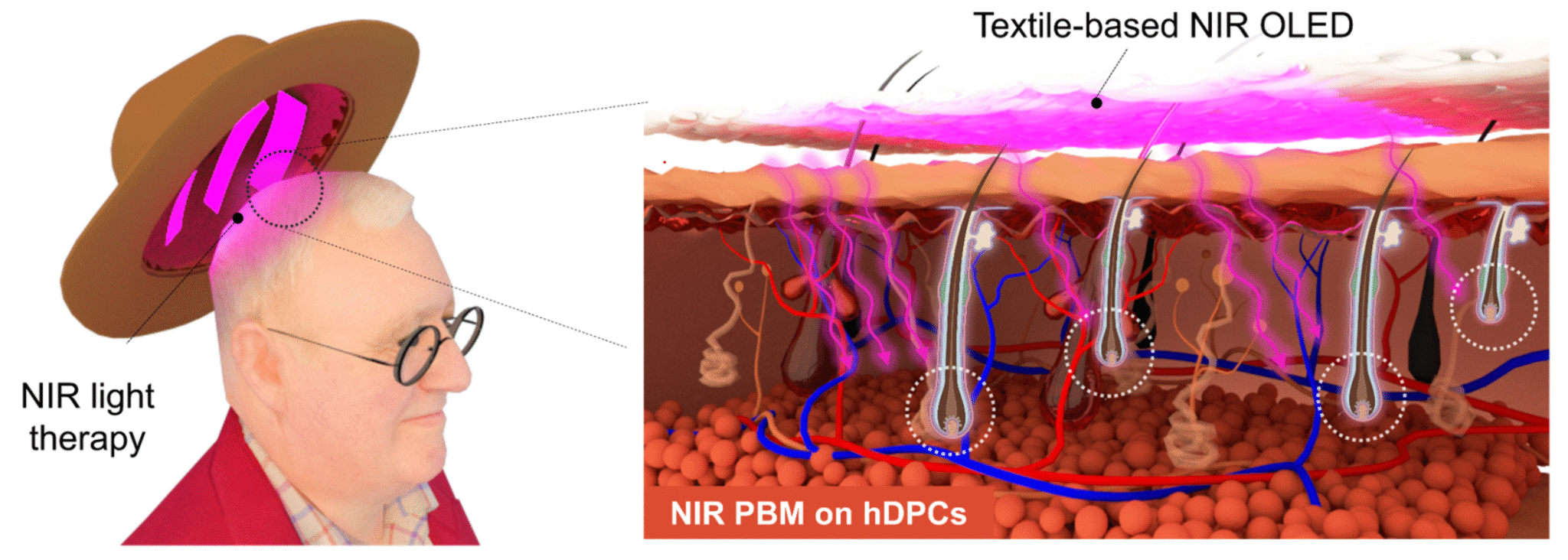 New Light Therapy Can Suppress a Key Marker of Hair Loss by 92% ...